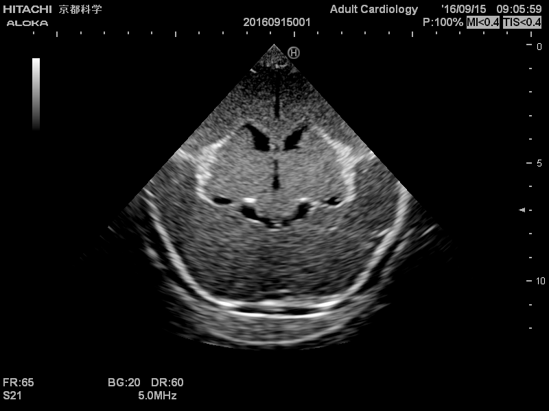KKUS-14a - Ultrasound Neonatal Head Phantom - Normal | Limbs & Things US