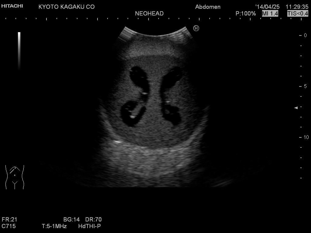 KKUS-14b - Ultrasound Neonatal Head Phantom - Abnormal | Limbs & Things UK